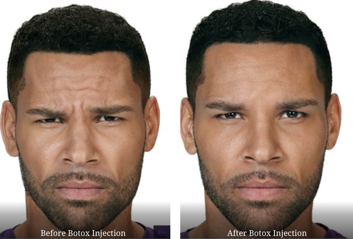 Botox Clinic in Washington DC | AnewSkin Medical Spa