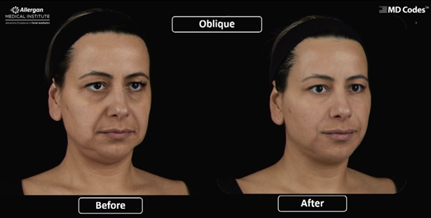 DERMAL FILLERS | AnewSkin Aesthetic Clinic and Medical Spa